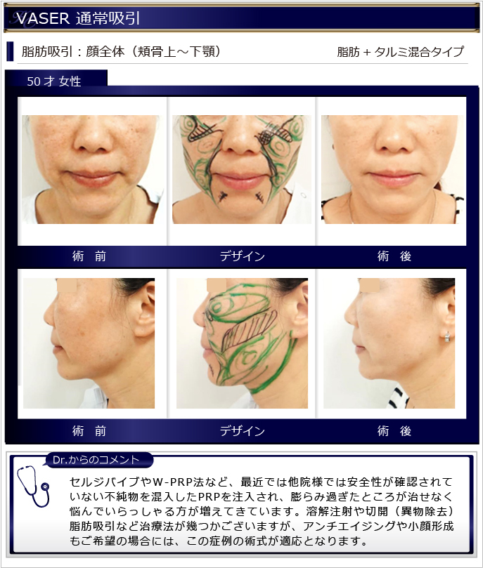 小顔形成 脂肪吸引|美容整形kunoクリニック 小顔整形